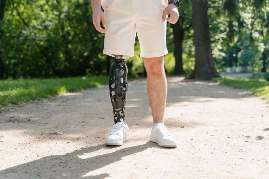 The Role of Physiotherapy in Recovery After Amputation